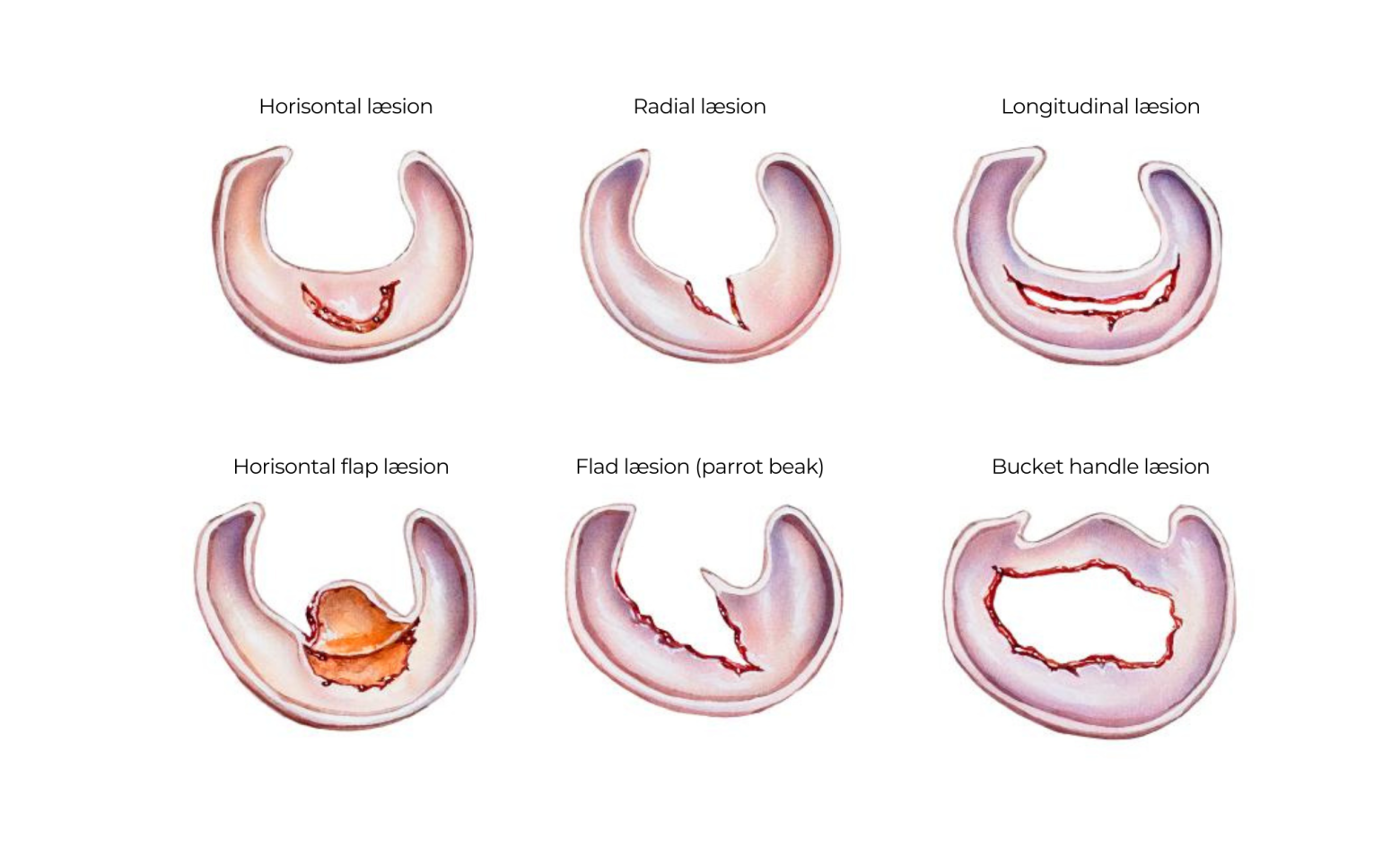 Meniskskader i knæet: Bliv smertefri uden operation I Smertefribevægelse