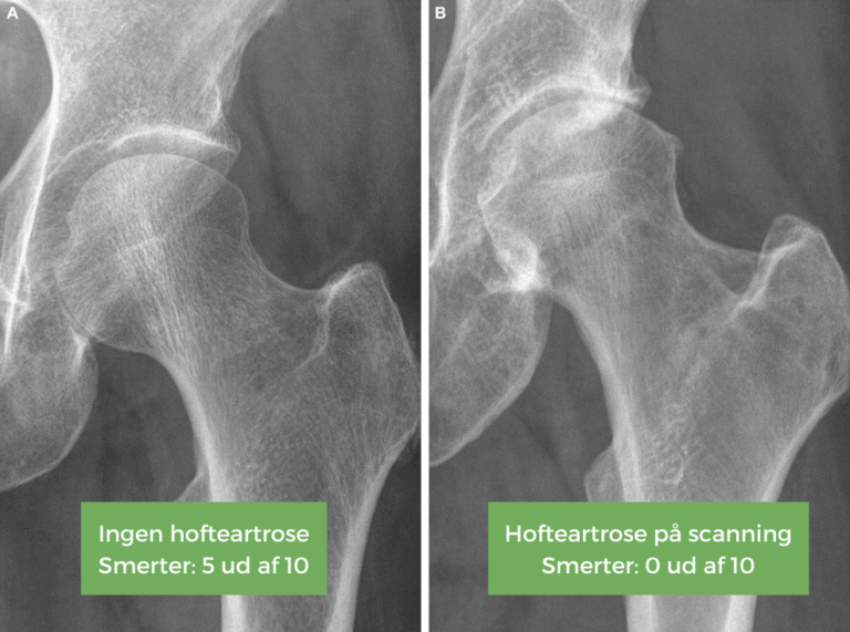 Slidgigt i hoften: Myter, viden, operation og genoptræning