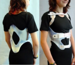 Scheuermann: Ingen begrænsning for et aktivt liv I Smertefribevægelse