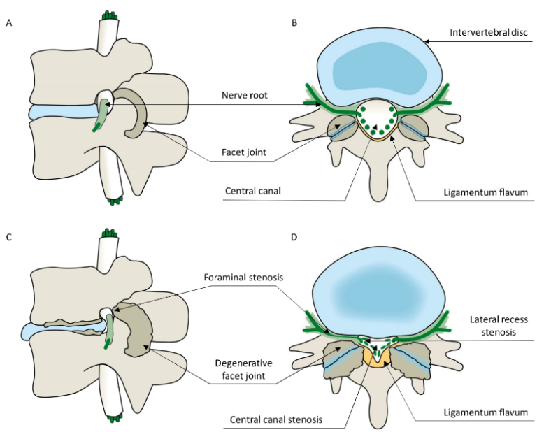 Spinalstenose i lænden: Sådan behandler du det selv | Smertefribevægelse